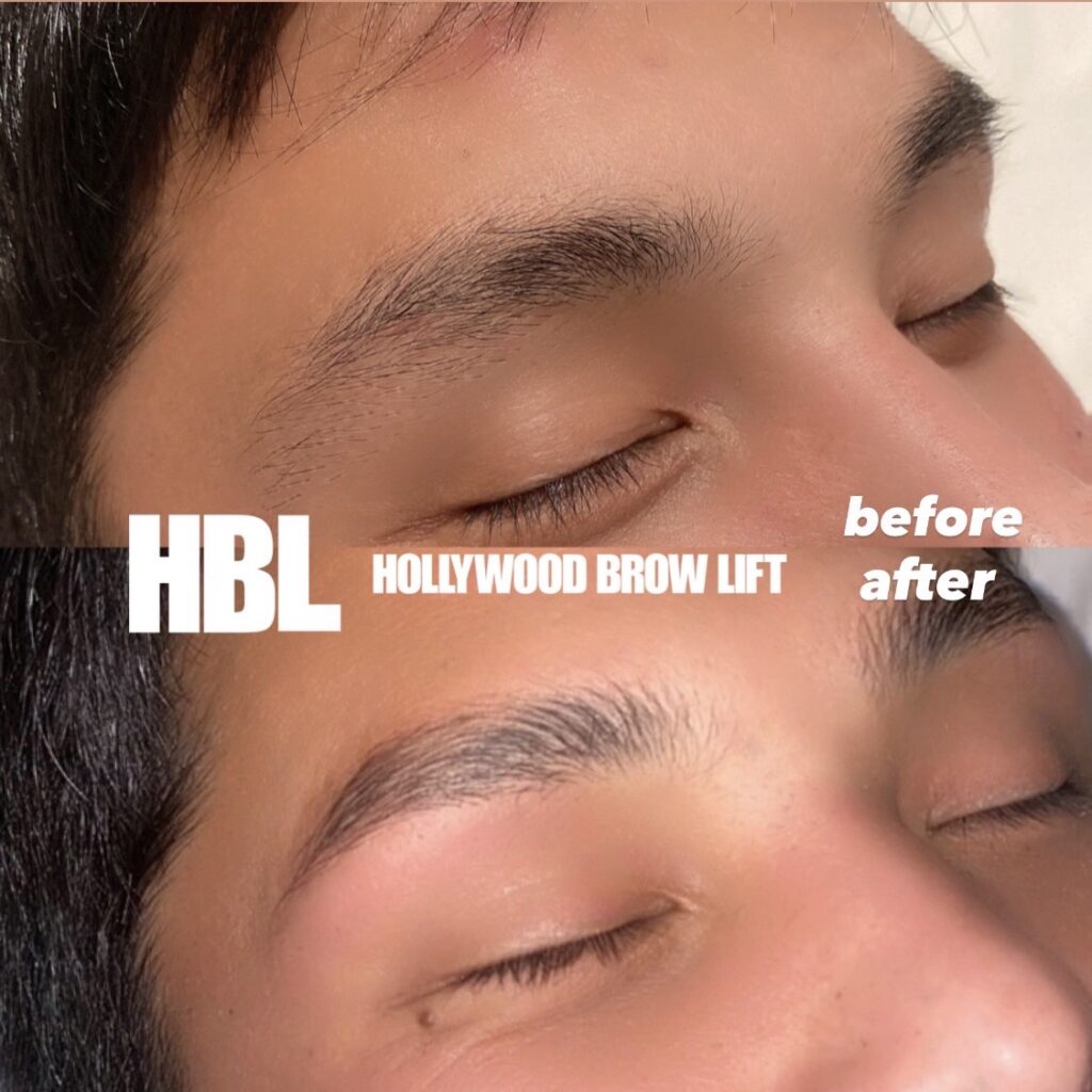 Hollywood Brow Lift(HBL)とは - リンパドレナージュ ラニカイ